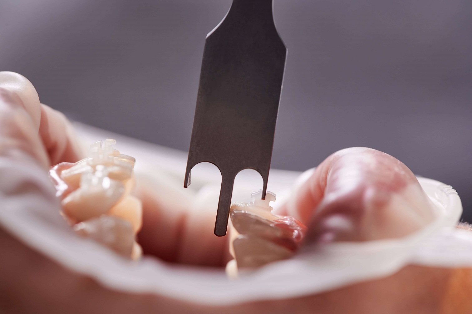 Conoce la colocación de brackets de autoligado en 3 pasos