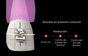 Conoce la colocación de brackets de autoligado en 3 pasos