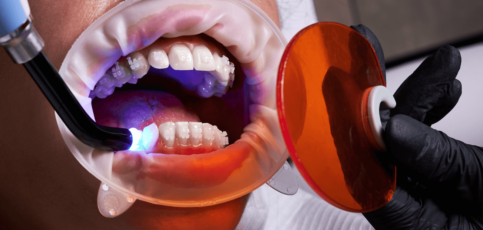 Cementado directo vs indirecto de brackets