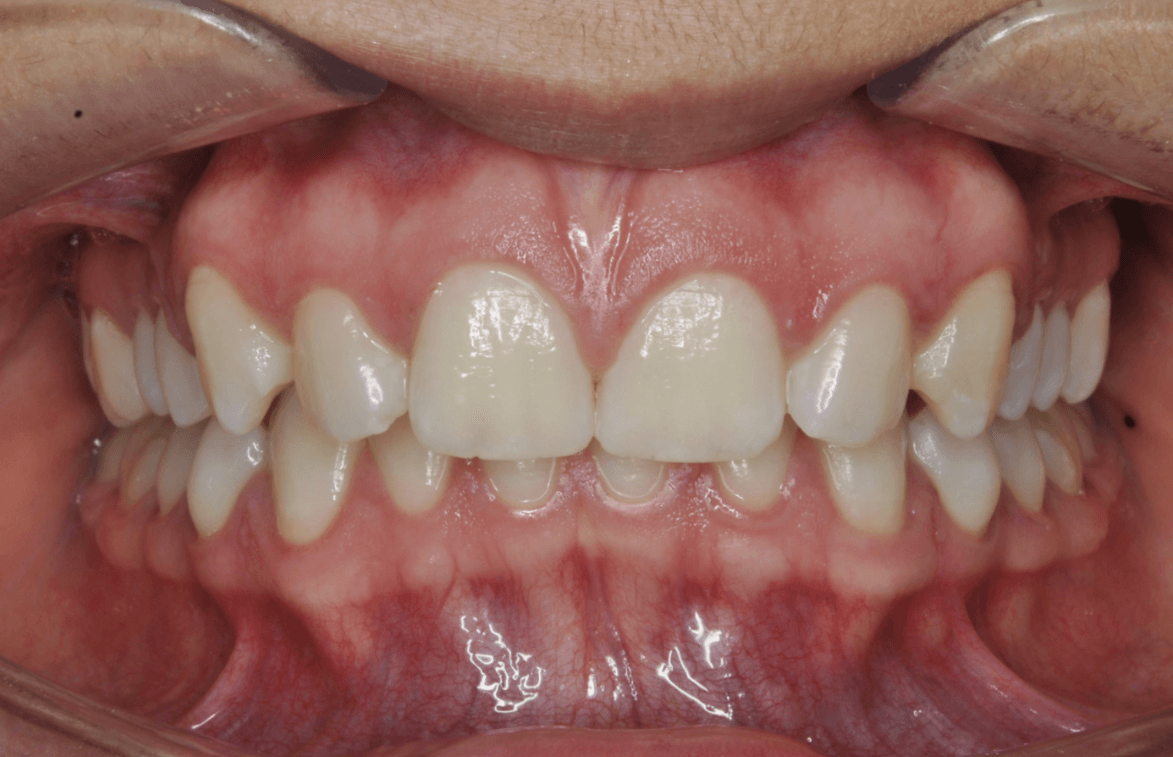 ¿Cómo resolver una mordida profunda con ortodoncia CCO?